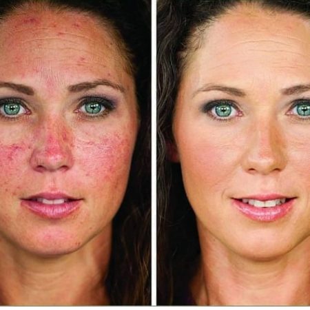 Tri-Luma Cream 15gm: Your Secret to Glowing Skin