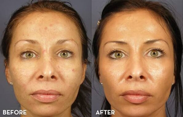 Tretinoin in Tri-Luma Cream: Best for Skin Renewal